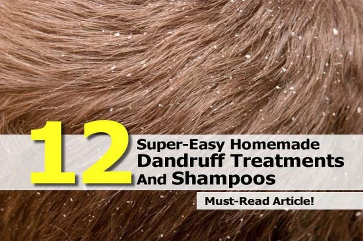 12 Homemade Dandruff Treatments & Shampoos – Anti-Aging, Beauty, Health ...
